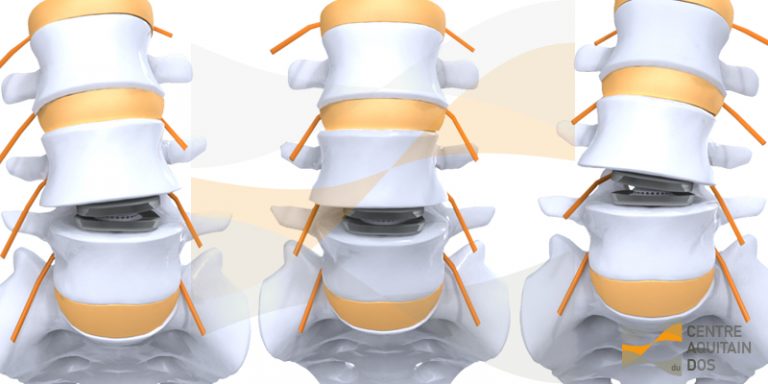 Centre Aquitain du dos : Interventions